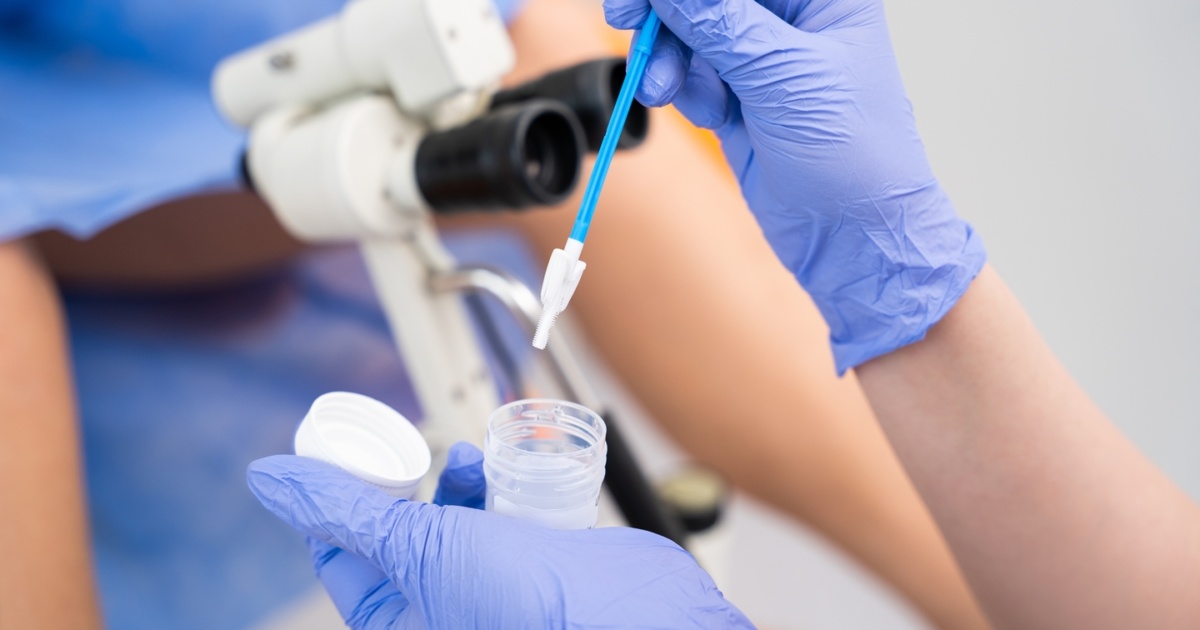 Kako se radi HPV tipizacija? | Poliklinika Sinteza